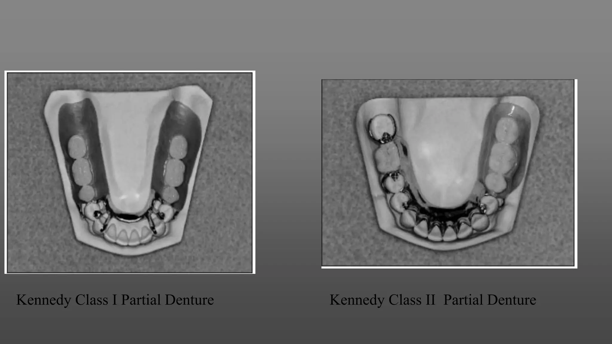 Introduction and Classification RPD | PPTX