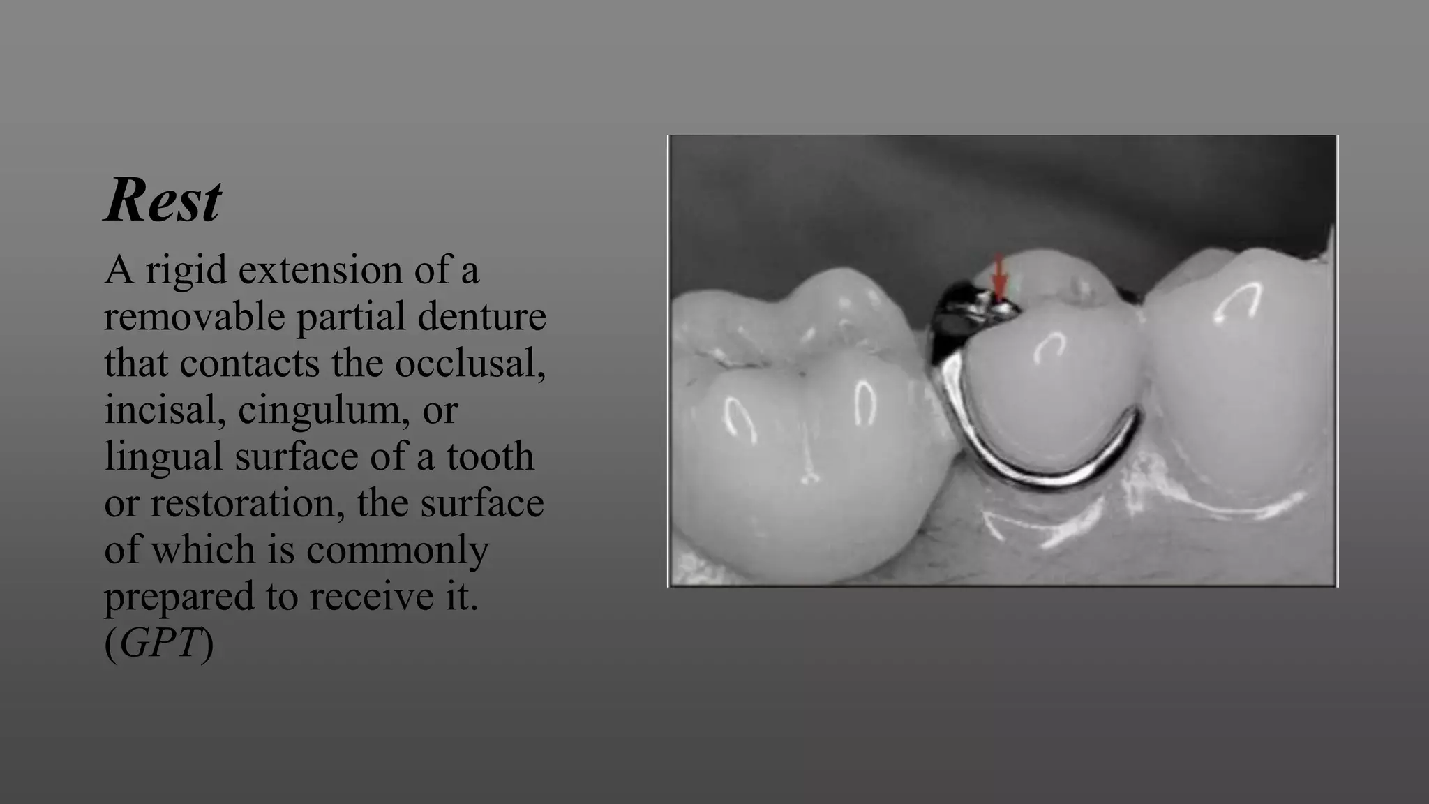 Introduction and Classification RPD | PPTX