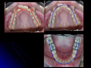 CLASSIFICATION OF NORMAL OCCLUSION AND MALOCCLUSION. | PPT