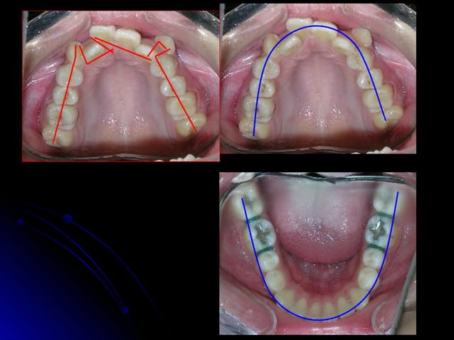 CLASSIFICATION OF NORMAL OCCLUSION AND MALOCCLUSION. | PPT | Dental ...