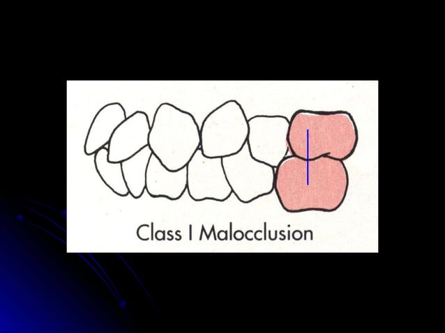CLASSIFICATION OF NORMAL OCCLUSION AND MALOCCLUSION. | PPT | Dental ...