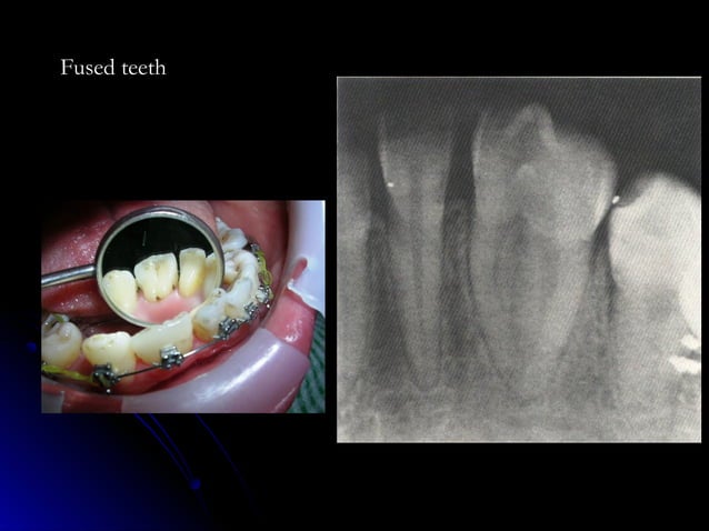 CLASSIFICATION OF NORMAL OCCLUSION AND MALOCCLUSION. | PPT | Dental ...