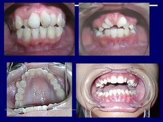 CLASSIFICATION OF NORMAL OCCLUSION AND MALOCCLUSION. | PPT