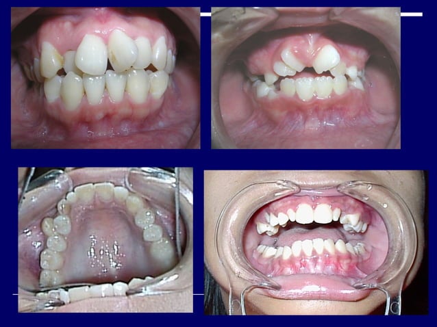 CLASSIFICATION OF NORMAL OCCLUSION AND MALOCCLUSION. | PPT | Dental ...