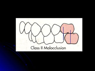 CLASSIFICATION OF NORMAL OCCLUSION AND MALOCCLUSION. | PPT