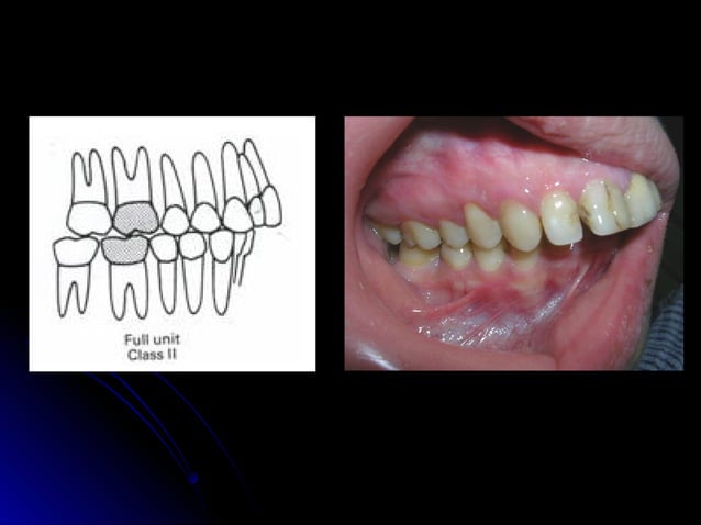 CLASSIFICATION OF NORMAL OCCLUSION AND MALOCCLUSION. | PPT | Dental ...
