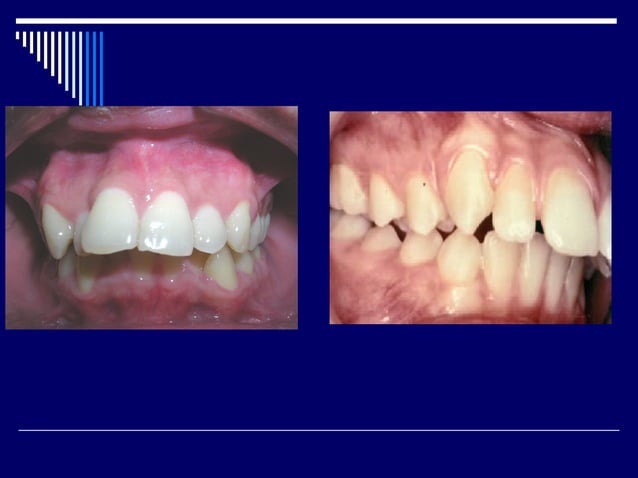 CLASSIFICATION OF NORMAL OCCLUSION AND MALOCCLUSION. | PPT | Dental ...