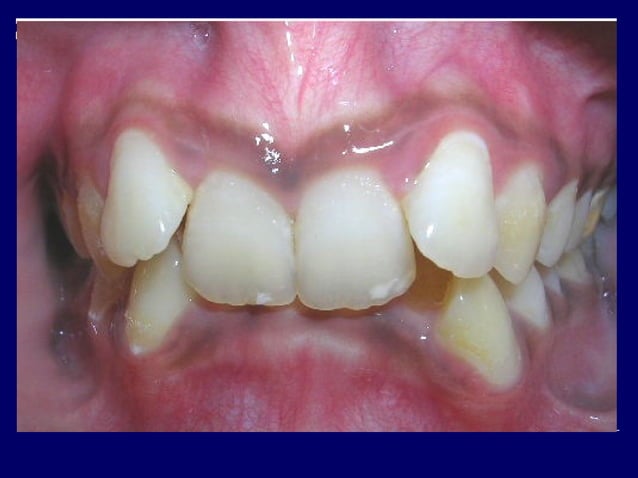 CLASSIFICATION OF NORMAL OCCLUSION AND MALOCCLUSION. | PPT | Dental ...