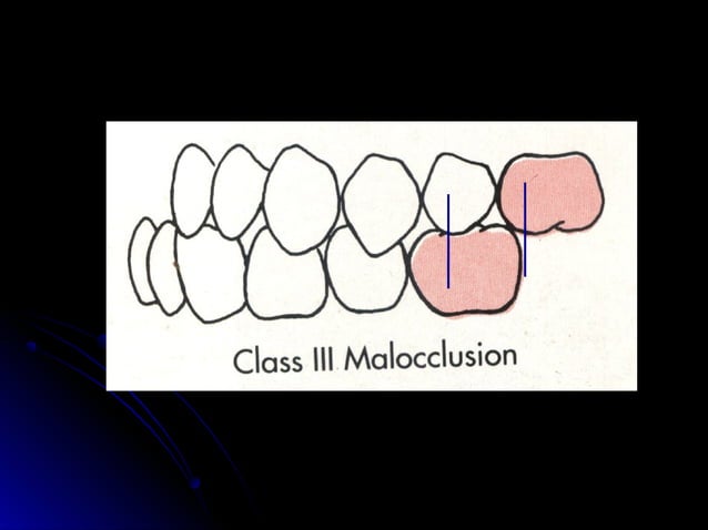 CLASSIFICATION OF NORMAL OCCLUSION AND MALOCCLUSION. | PPT | Dental ...