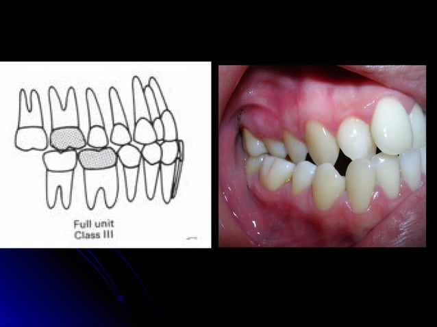 CLASSIFICATION OF NORMAL OCCLUSION AND MALOCCLUSION. | PPT | Dental ...