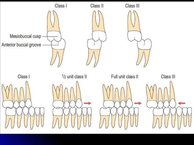 CLASSIFICATION OF NORMAL OCCLUSION AND MALOCCLUSION. | PPT | Dental ...