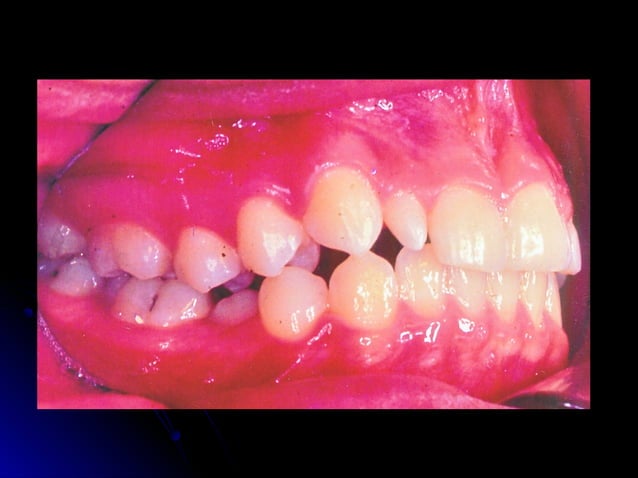 CLASSIFICATION OF NORMAL OCCLUSION AND MALOCCLUSION. | PPT | Dental ...