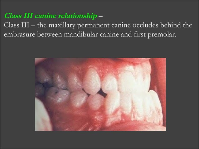 CLASSIFICATION OF NORMAL OCCLUSION AND MALOCCLUSION. | PPT | Dental ...