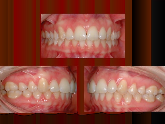 CLASSIFICATION OF NORMAL OCCLUSION AND MALOCCLUSION. | PPT | Dental ...