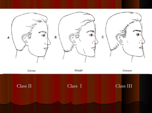 CLASSIFICATION OF NORMAL OCCLUSION AND MALOCCLUSION. | PPT | Dental ...