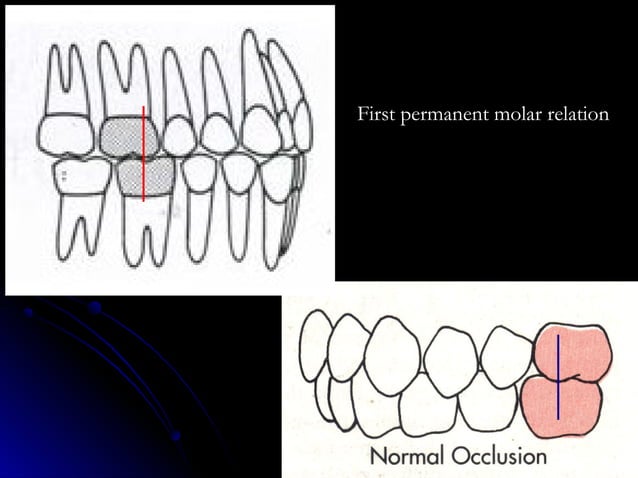 CLASSIFICATION OF NORMAL OCCLUSION AND MALOCCLUSION. | PPT | Dental ...