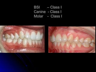 CLASSIFICATION OF NORMAL OCCLUSION AND MALOCCLUSION. | PPT