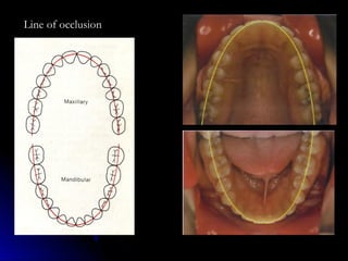 CLASSIFICATION OF NORMAL OCCLUSION AND MALOCCLUSION. | PPT