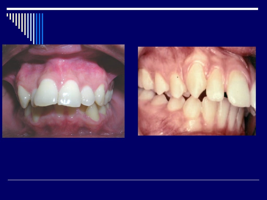 Normal Occlusion Vs Class 1 At Peggy Rios Blog