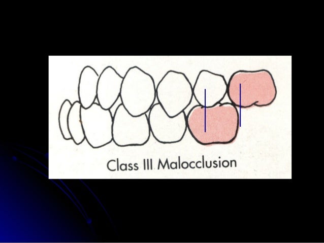 Classification Of Normal Occlusion And Malocclusion