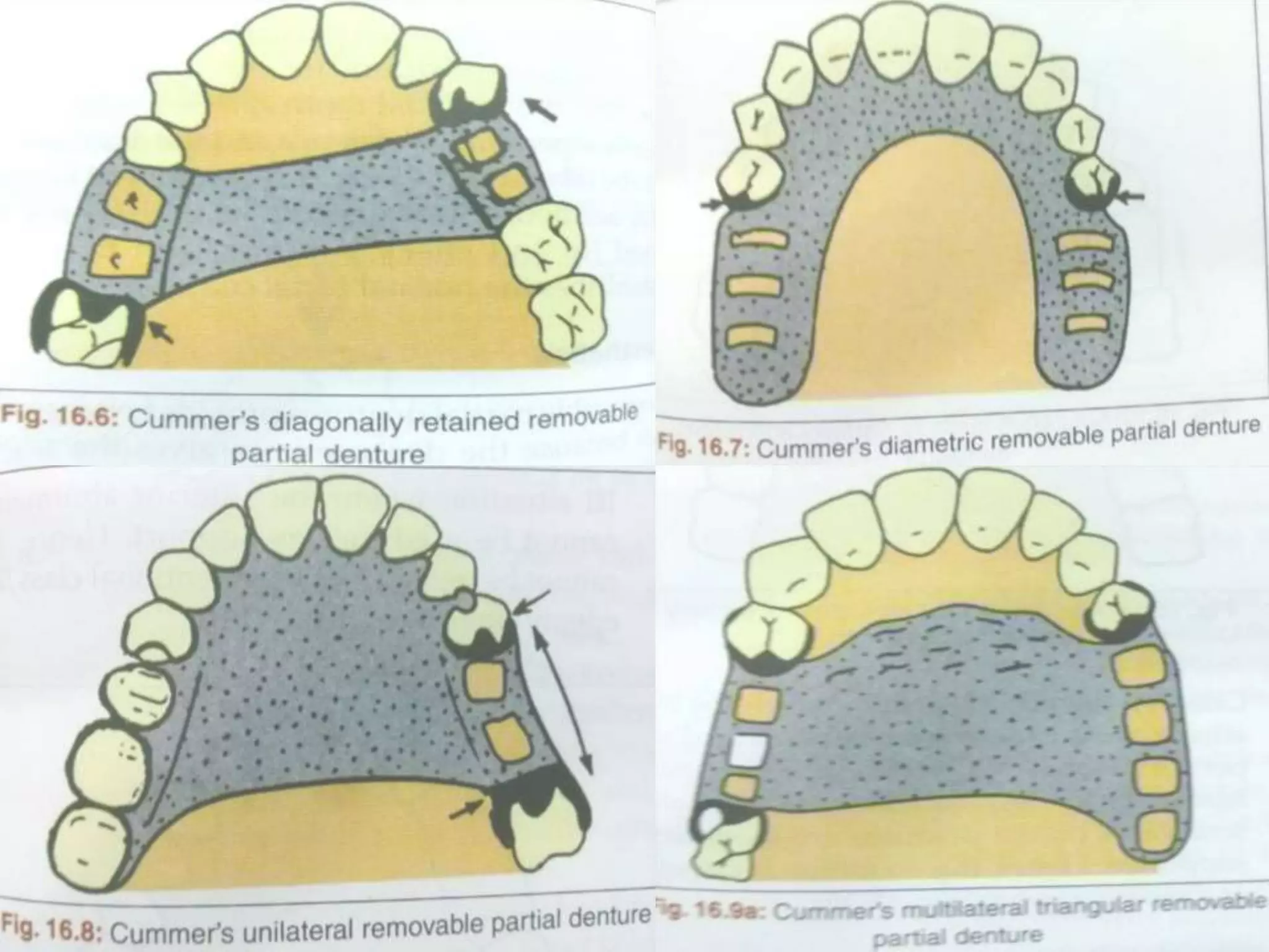 Introduction & classification of removable partial denture | PPTX