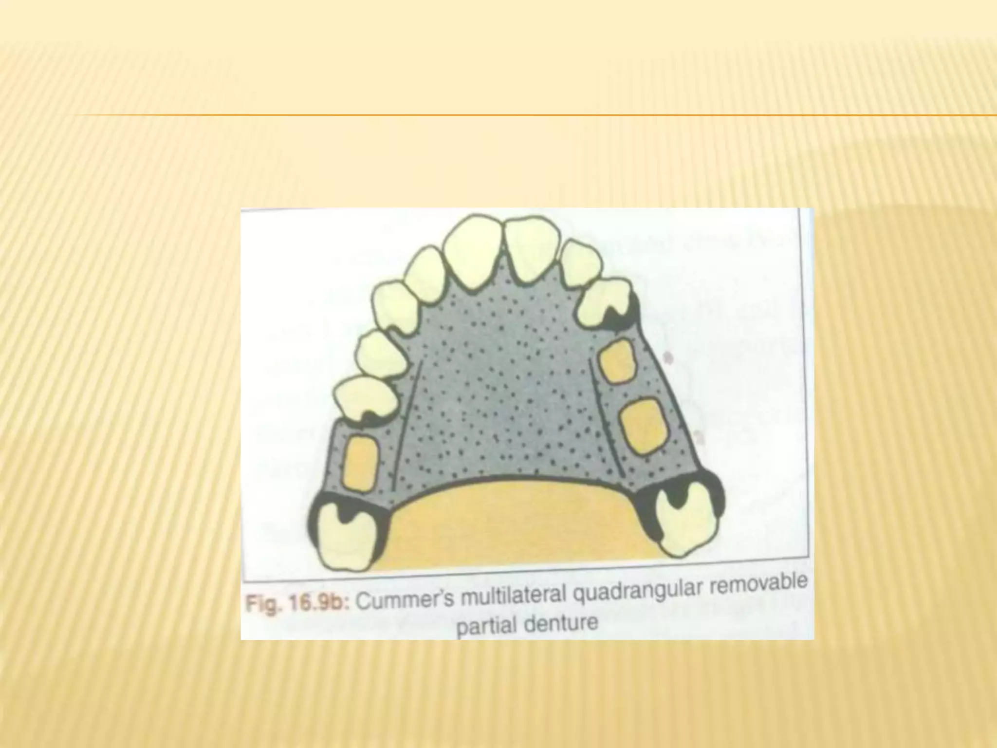 Introduction & classification of removable partial denture | PPTX