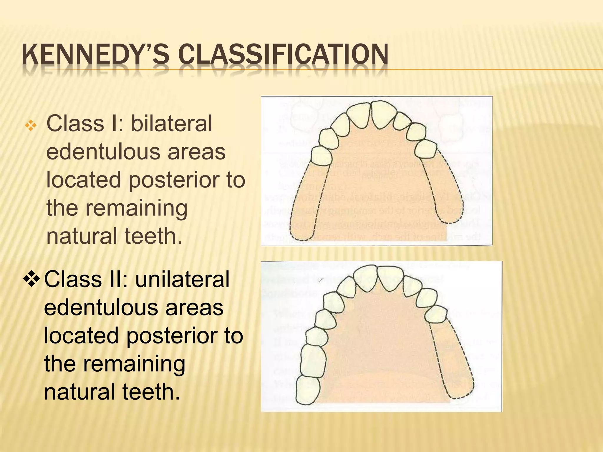 Introduction & classification of removable partial denture | PPTX