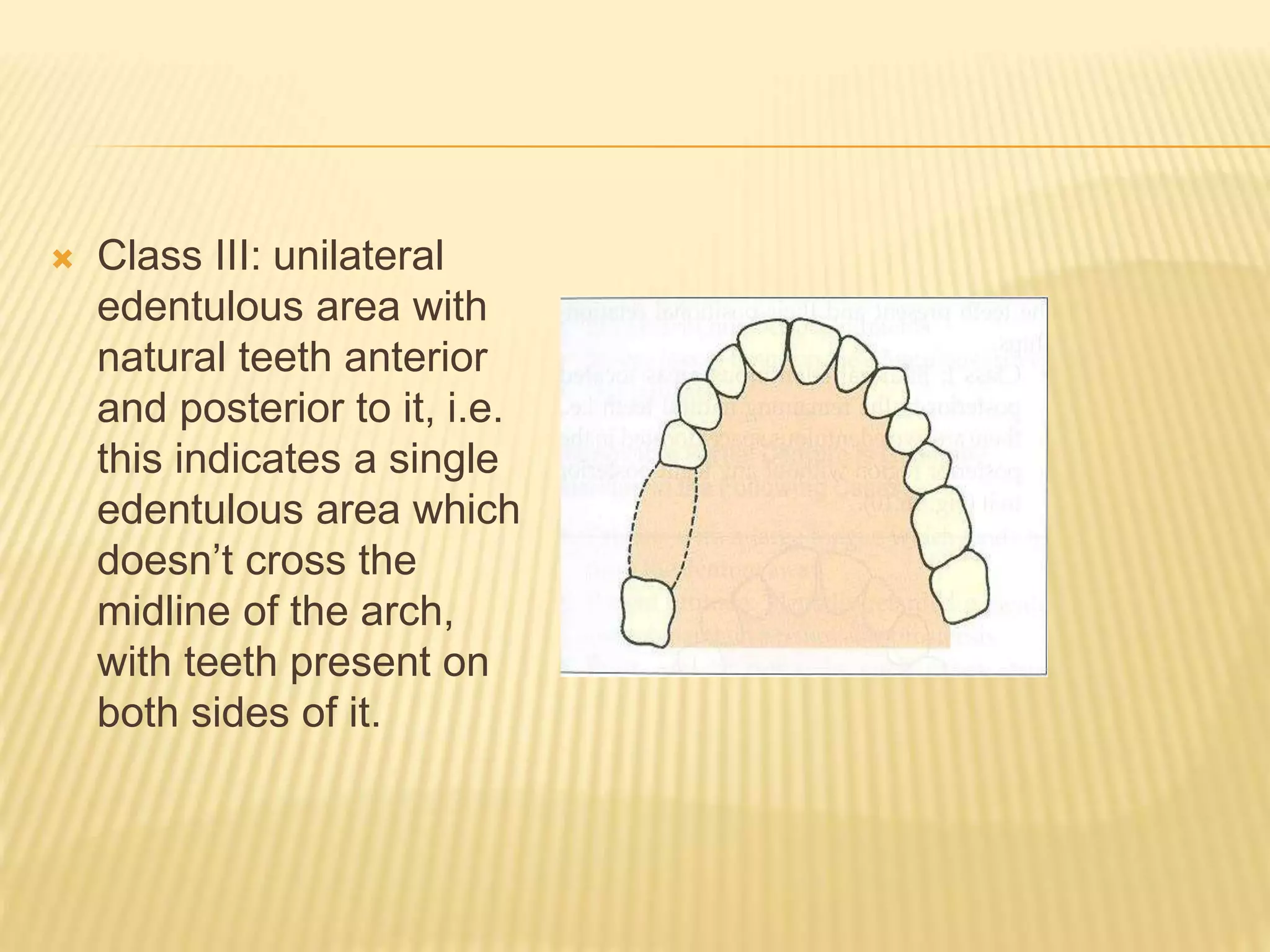Introduction & classification of removable partial denture | PPTX