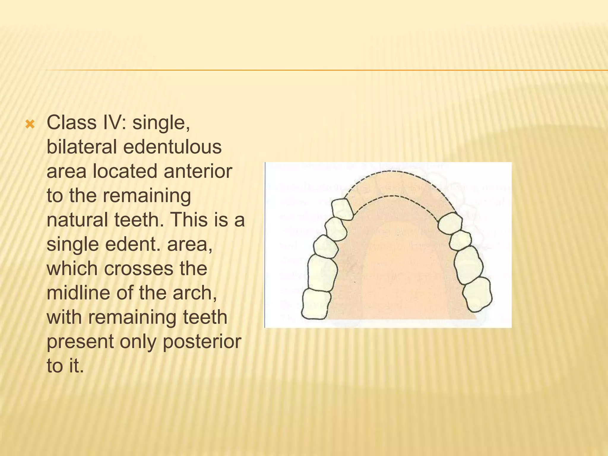 Introduction & classification of removable partial denture | PPTX
