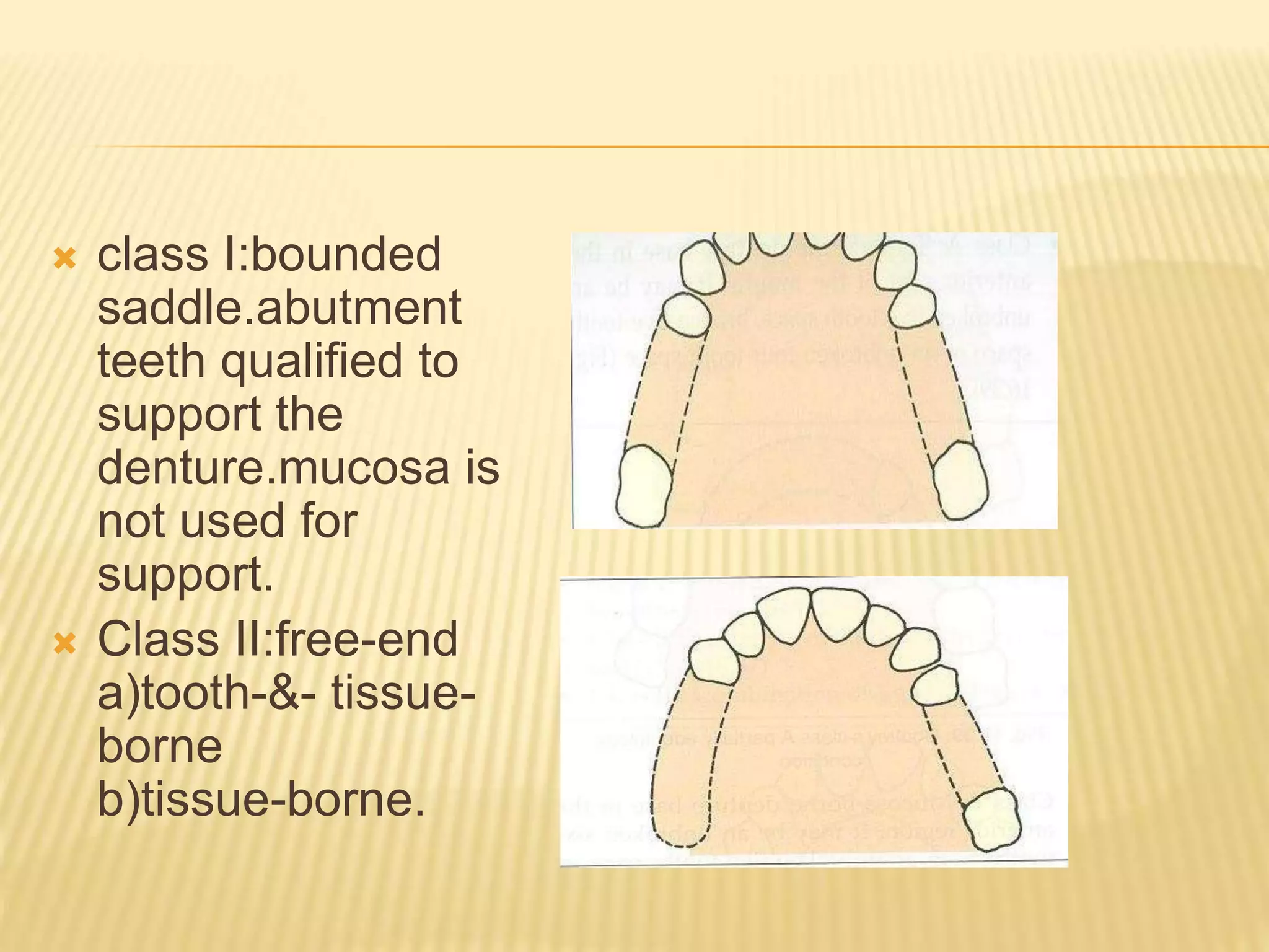 Introduction & classification of removable partial denture | PPTX
