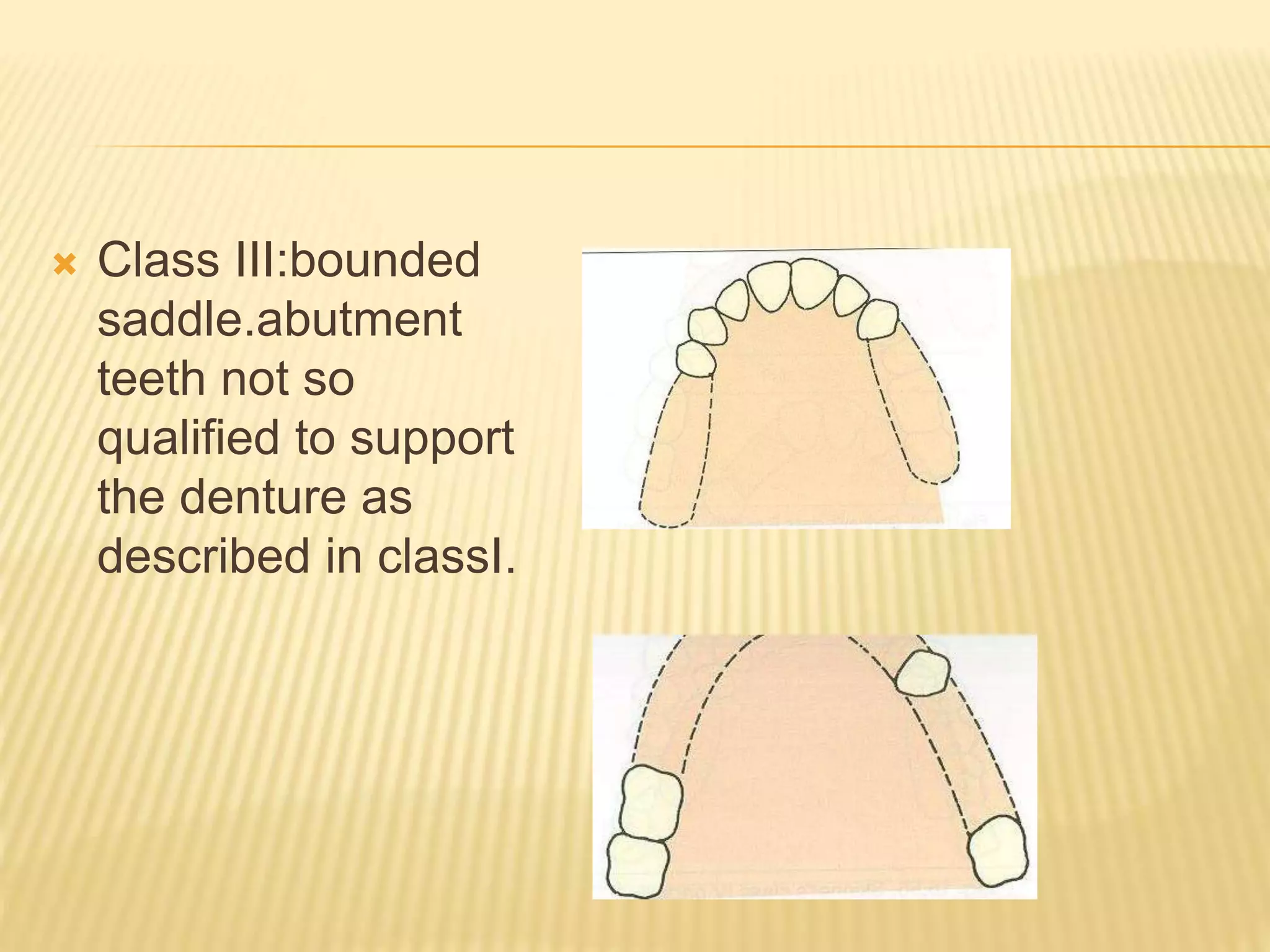 Introduction & classification of removable partial denture | PPTX