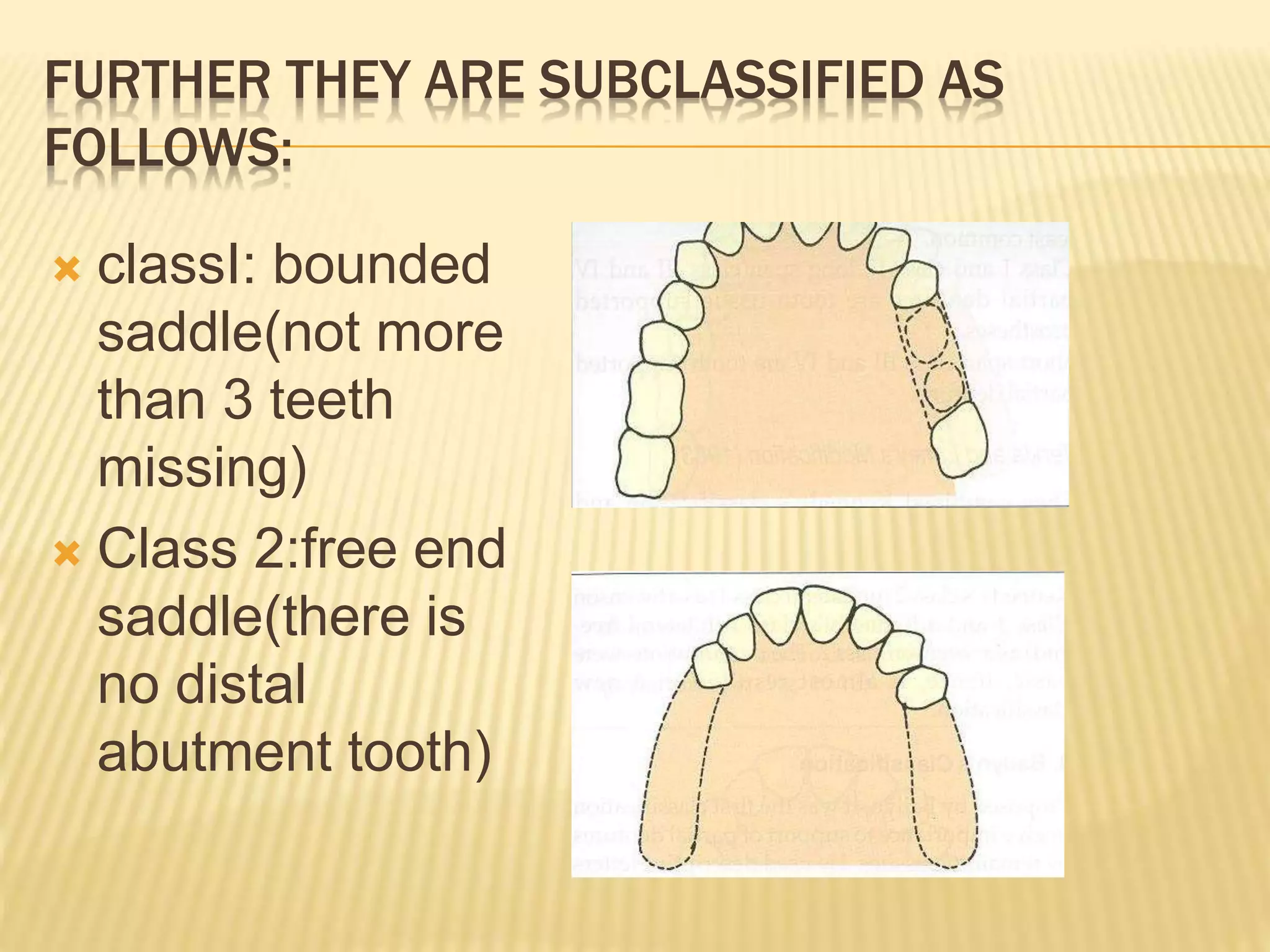 Introduction & classification of removable partial denture | PPTX