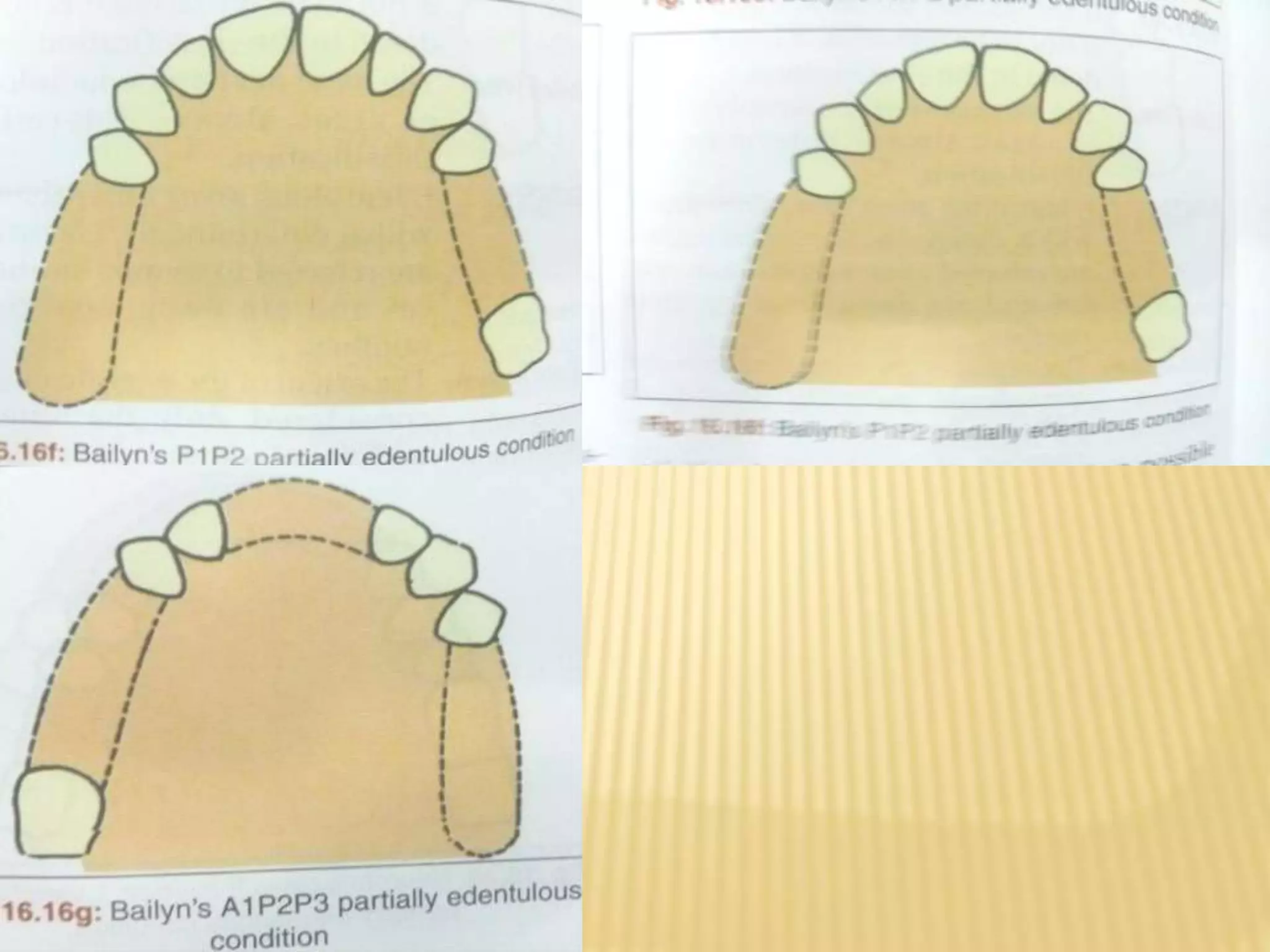 Introduction & classification of removable partial denture | PPTX