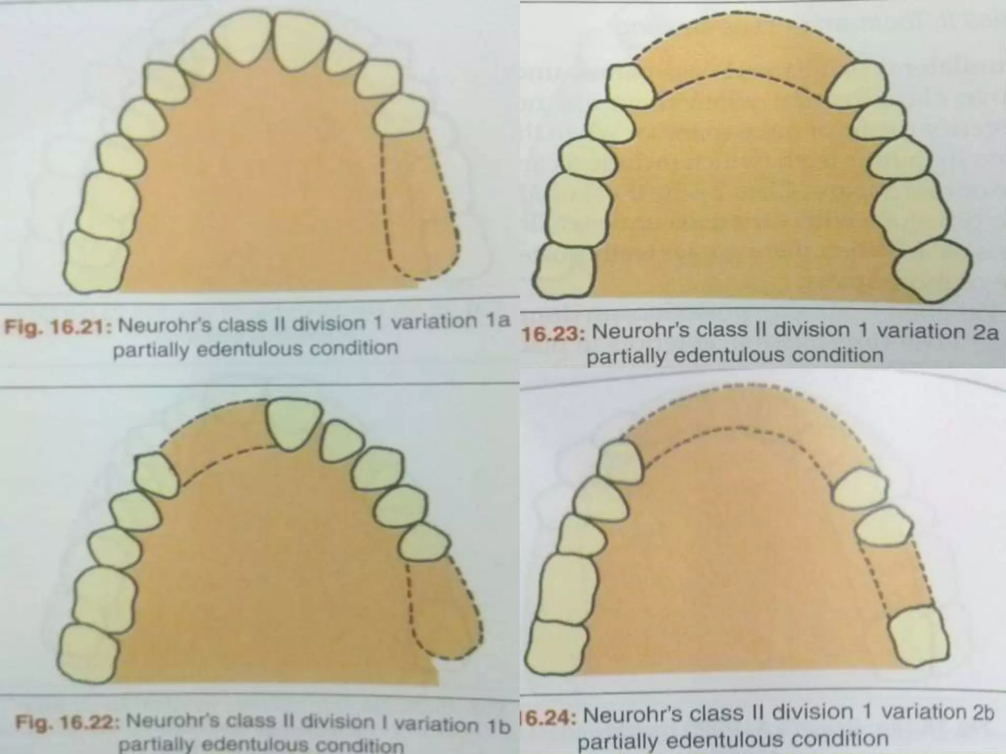 Introduction & classification of removable partial denture | PPTX