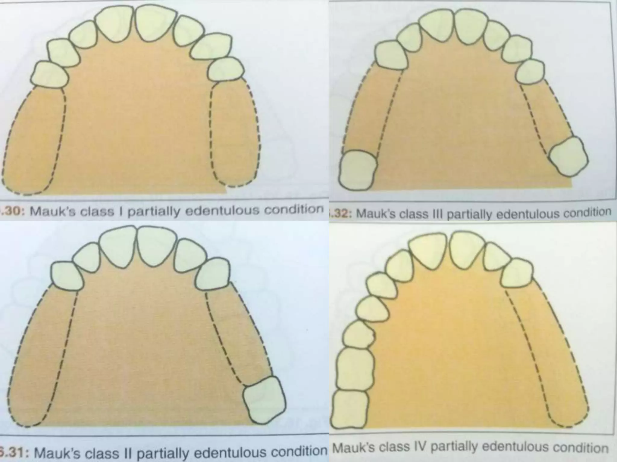 Introduction & classification of removable partial denture | PPTX