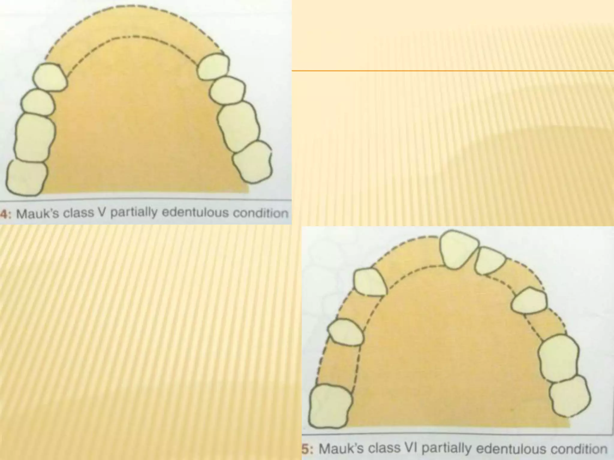 Introduction & classification of removable partial denture | PPTX
