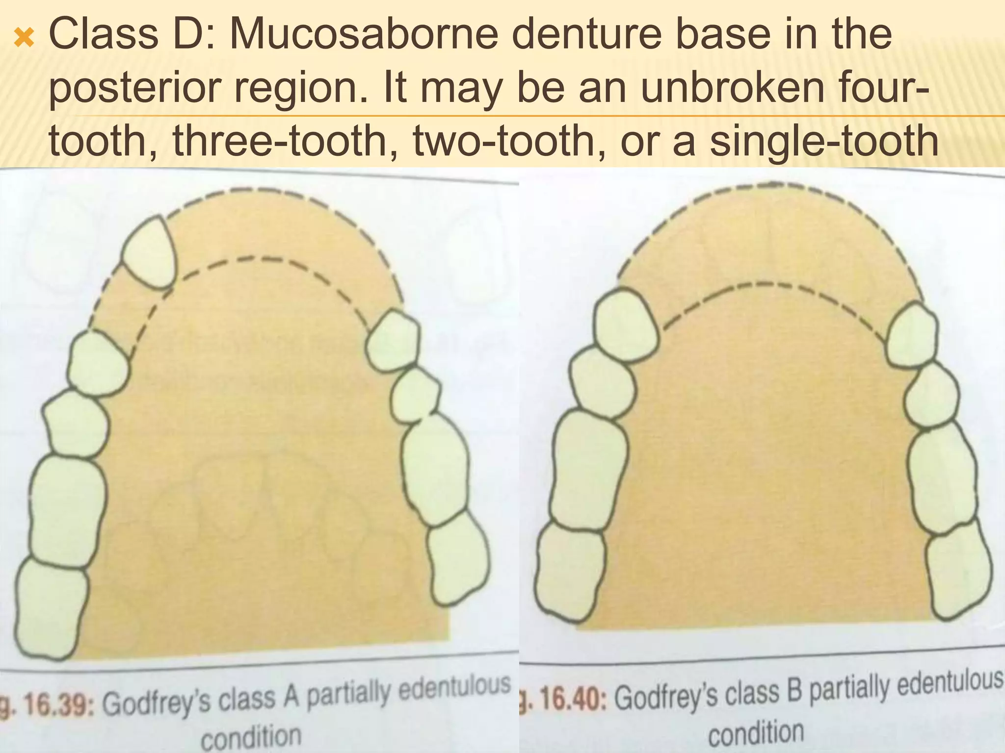 Introduction & classification of removable partial denture | PPTX