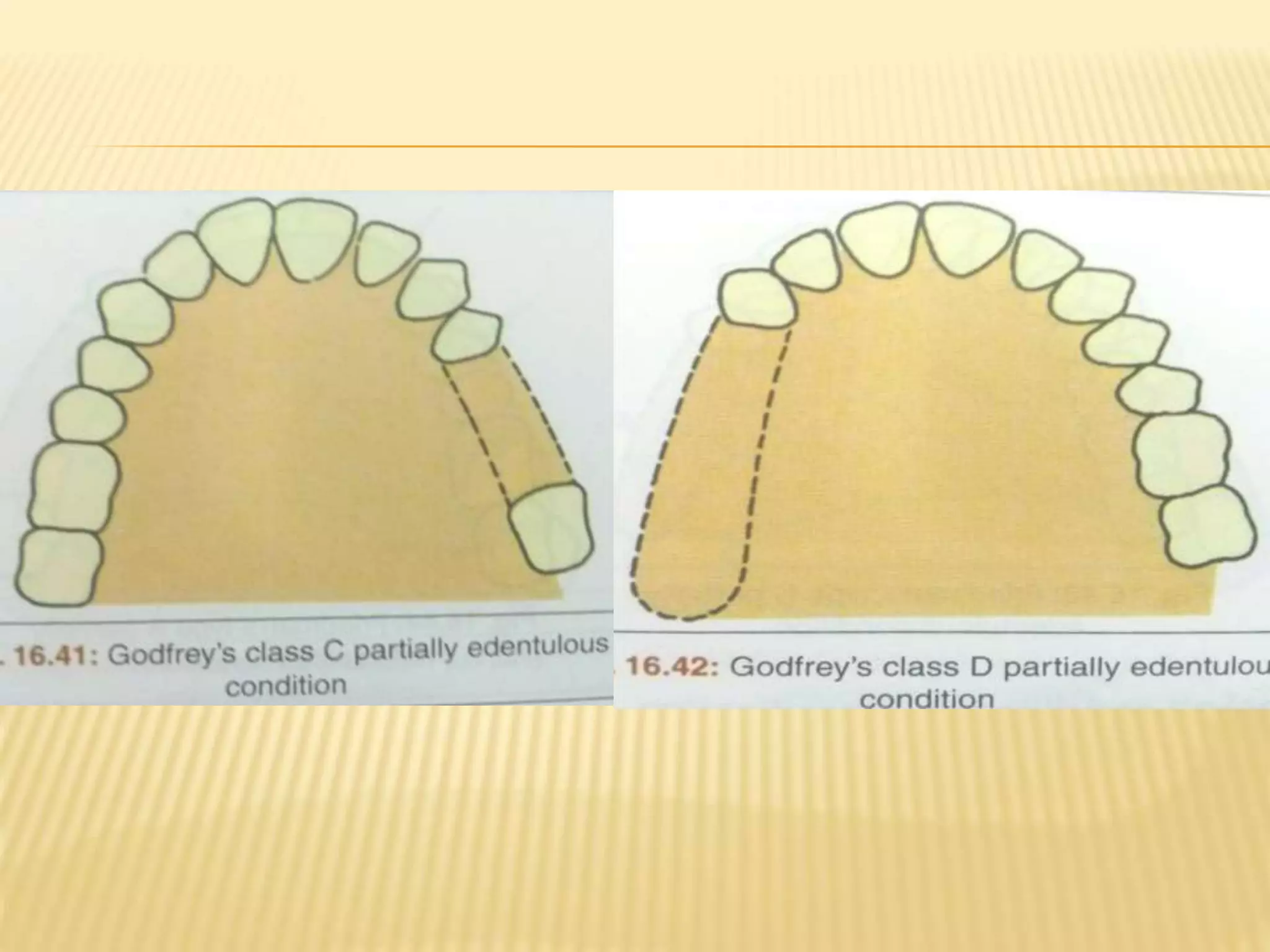 Introduction & classification of removable partial denture | PPTX