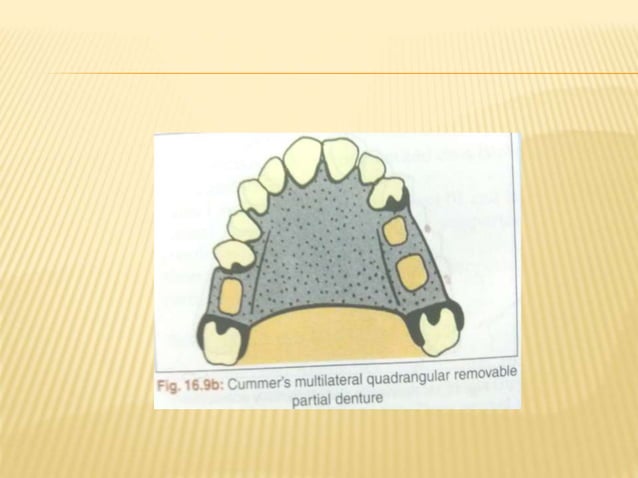 Introduction And Classification Of Removable Partial Denture Pptx