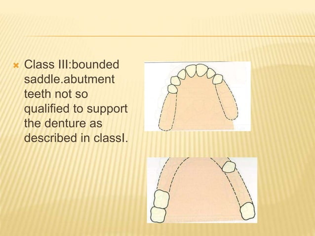 Introduction & classification of removable partial denture | PPTX