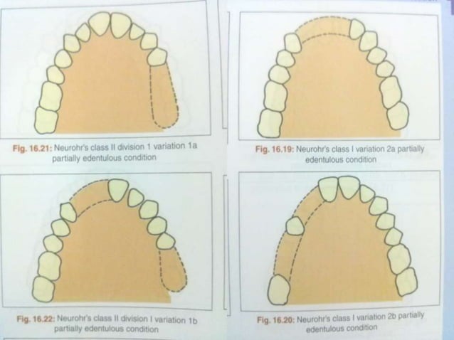 Introduction & classification of removable partial denture | PPTX