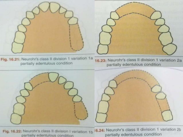 Introduction & classification of removable partial denture | PPTX
