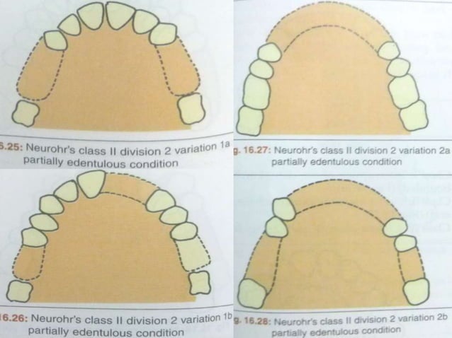 Introduction & classification of removable partial denture | PPTX