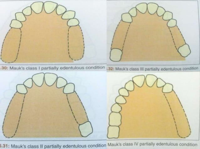 Introduction & classification of removable partial denture | PPTX