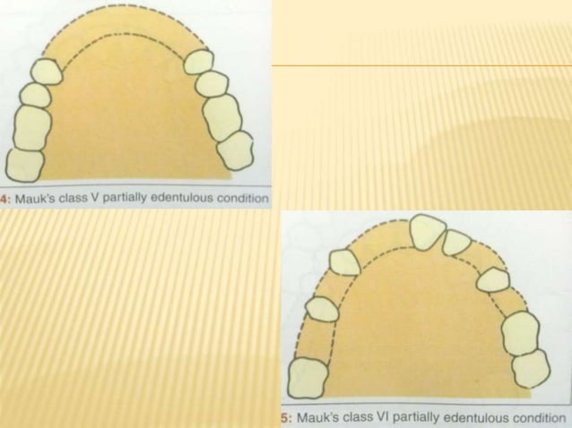 Introduction & classification of removable partial denture | PPTX