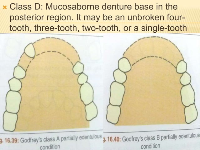 Introduction & classification of removable partial denture | PPTX