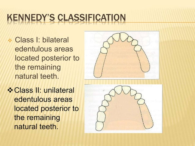 Introduction & classification of removable partial denture