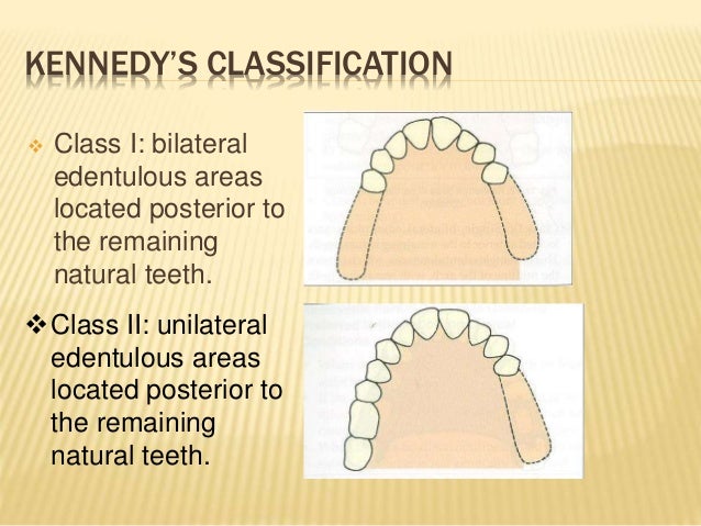 Introduction & classification of removable partial denture
