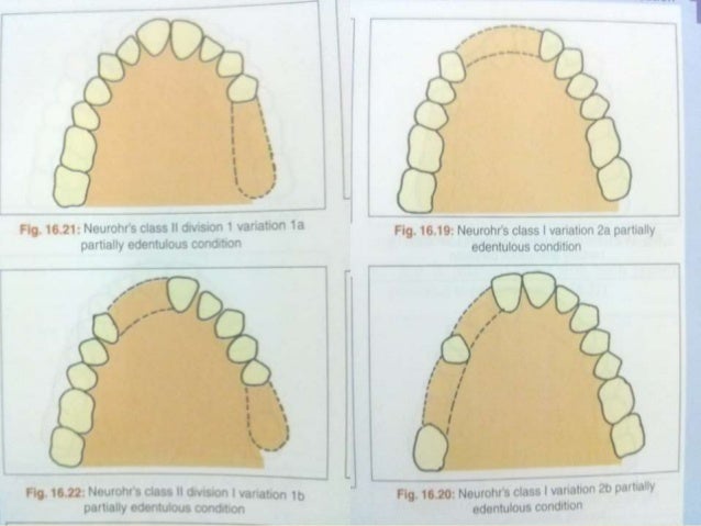 Introduction & classification of removable partial denture