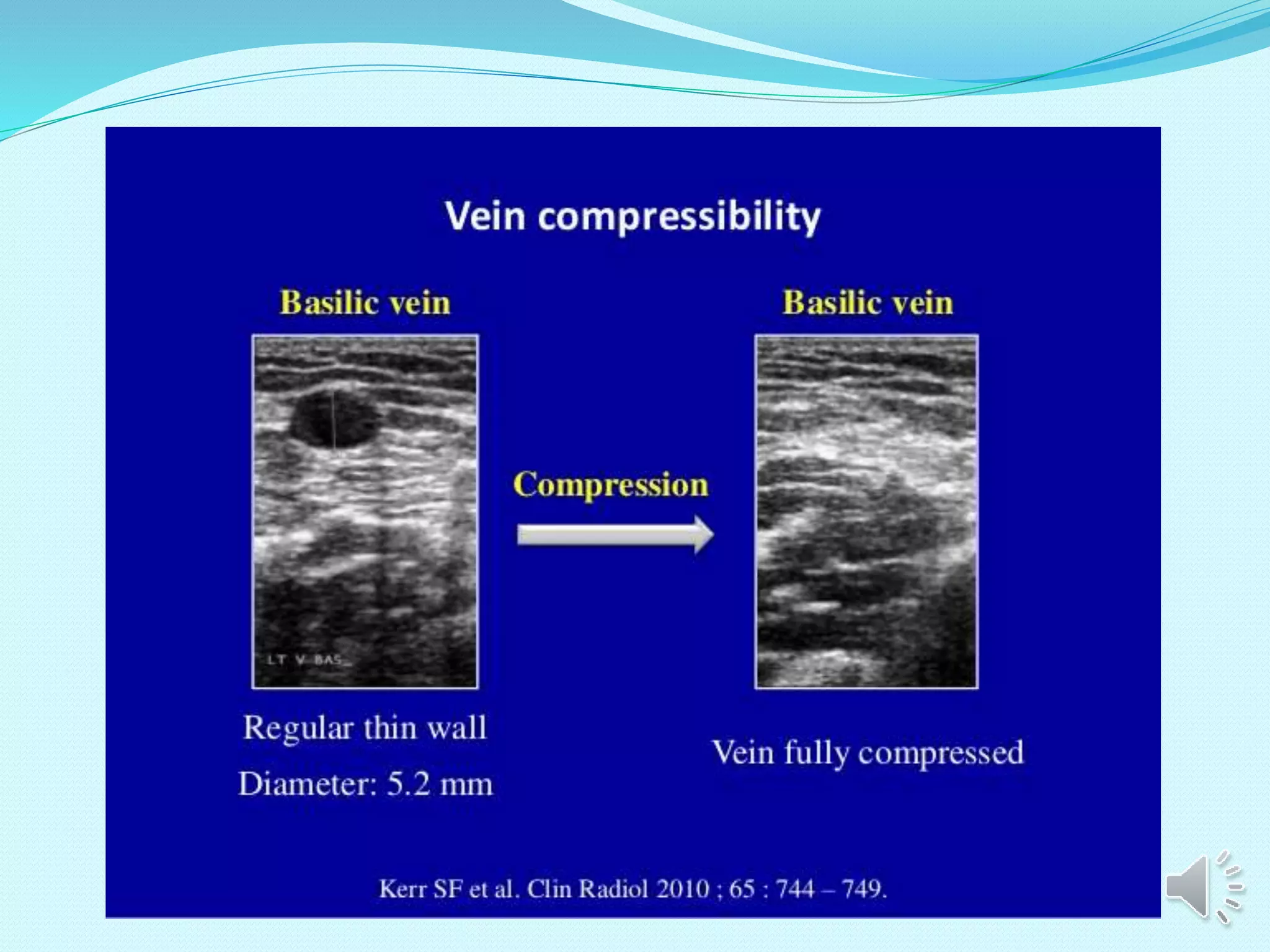 Introduction course to Ultrasound Vascular Access | PPTX